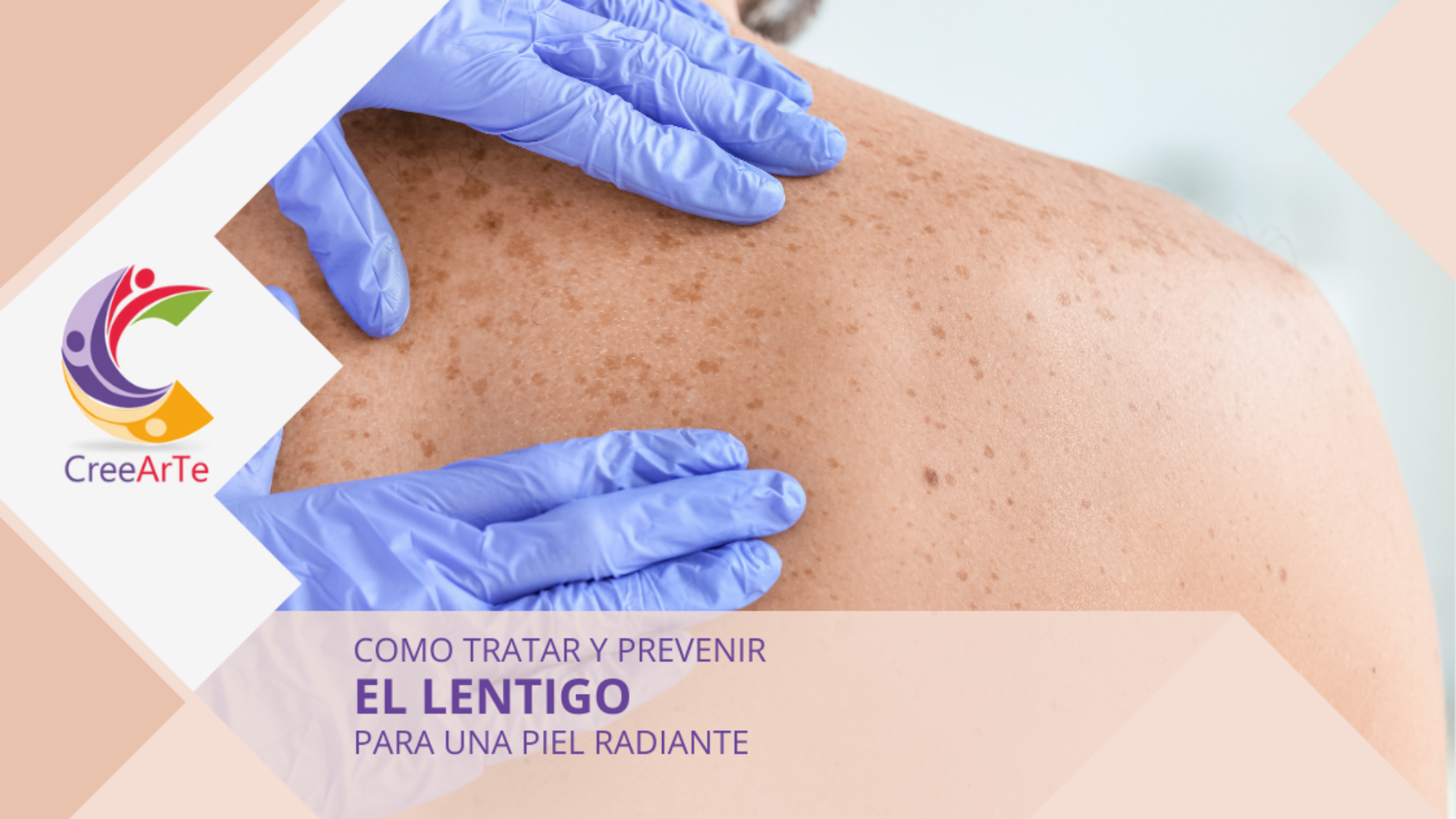 Como Tratar y Prevenir el Lentigo para una Piel Radiante: ¡Descubre la ...